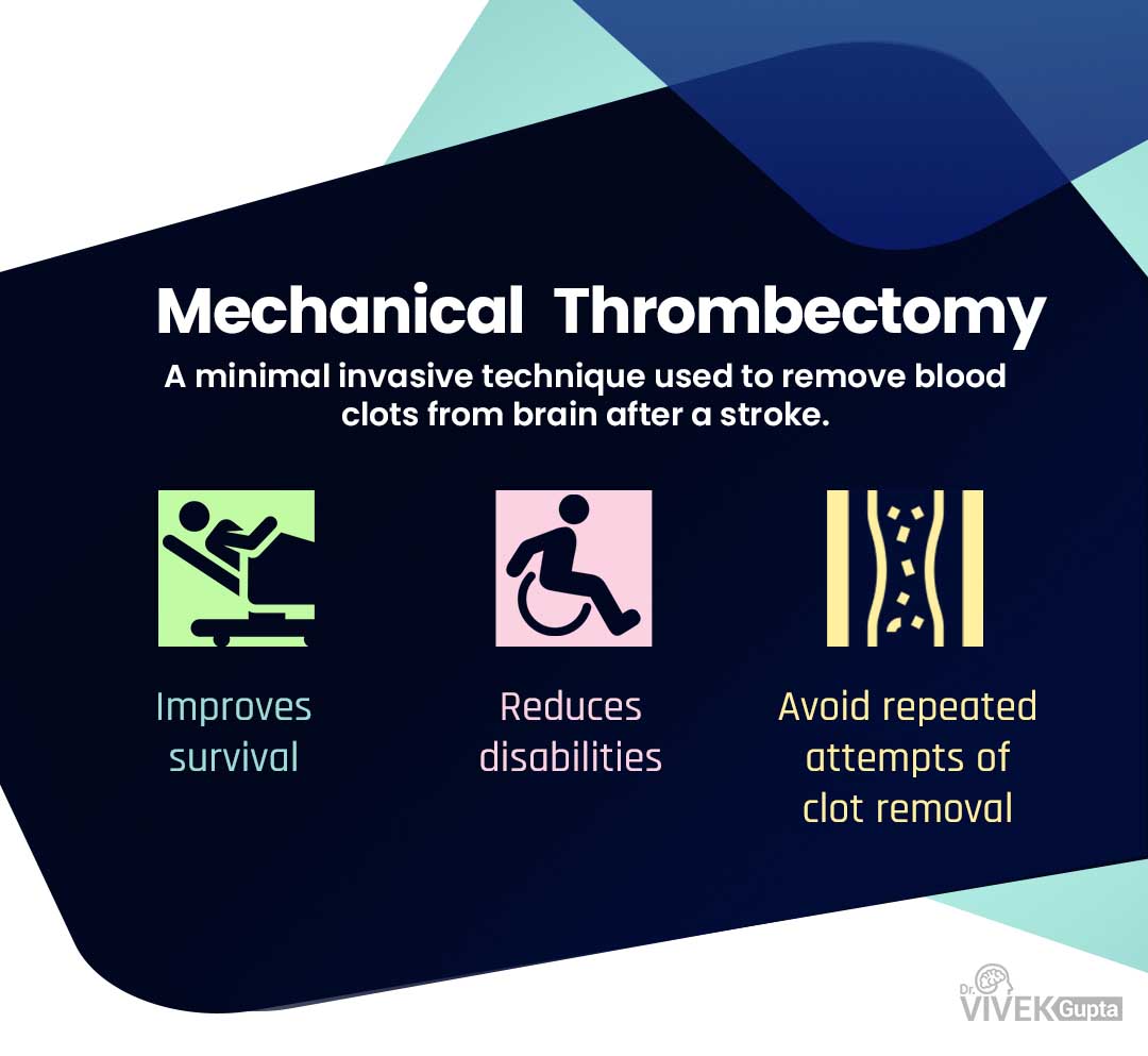 Mechanical Thrombectomy Procedure For Stroke | Dr Vivek Gupta