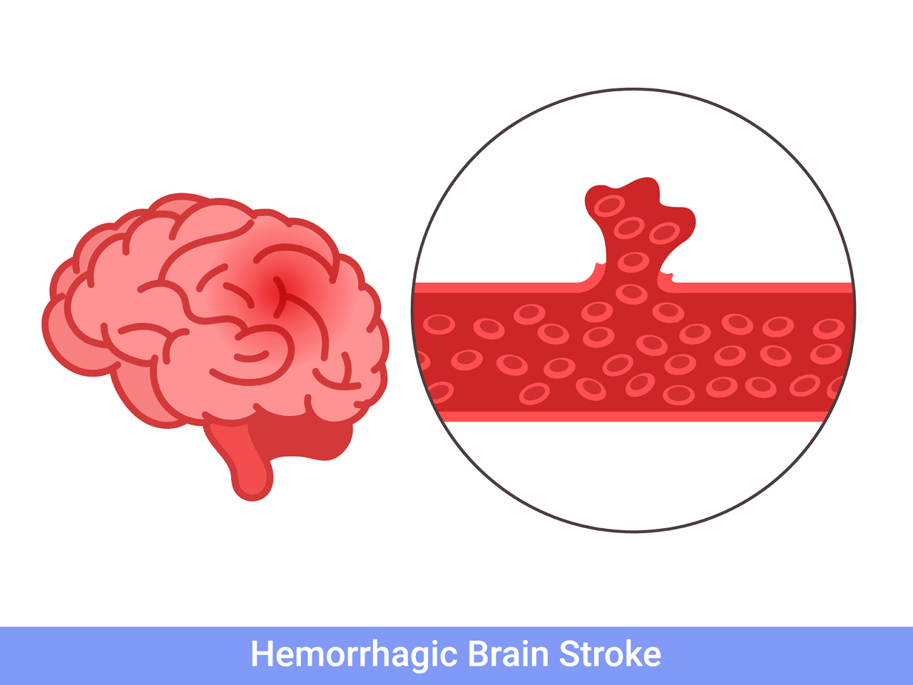 Understanding Hemorrhagic Stroke: Causes, Symptoms, and Prevention | Dr ...